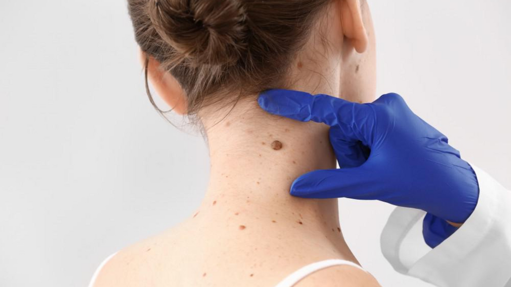 What to look out for: harmless mole or potential skin cancer? – Solbari UK